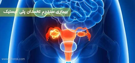 بیماری سندرم تخمدان پلی کیستیک چیست؟ عطاری آنلاین عطارک
