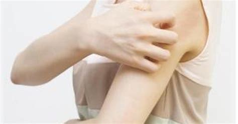 모기 물린 자리 거뭇하게 자국 남는 이유는