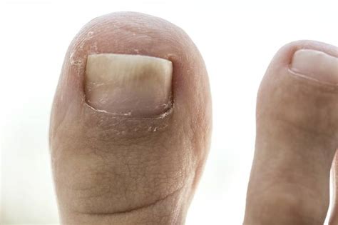 발톱에 변화 없어도 바로 아래 피부 ‘이런 변화 생기면… 무좀 생겼다는 신호