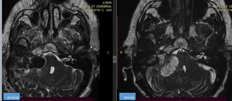 Mohamad Yazbeck On Linkedin Partial Resection During Previous Intervention Abroad Failure Of The