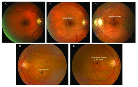 Illustration Of The Beckmans Clinical Classification Of Amd Based On