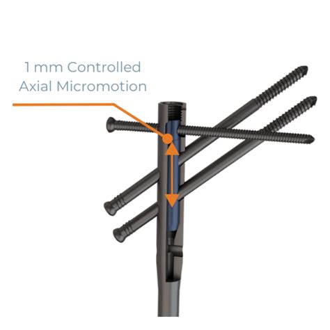 Apex Femoral Antegrade Nailing System Orthoxel