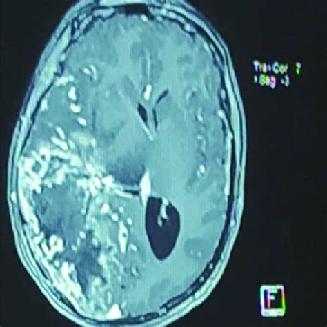 Brain Mri Noting A Hypervascularized Right Intra Axial Download Scientific Diagram