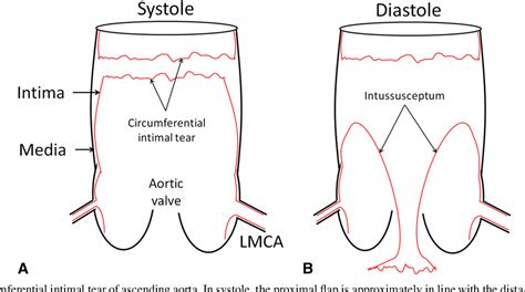 Figure 1 From Circumferential Intimal Tear In Type A Aortic Dissection With Intimo Intimal