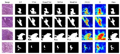 针对超大规模病理图像分析！华中科技大学提出医学图像分割模型，提高干燥综合征诊断准确性 资讯 Hyperai超神经 Hyperai超神经