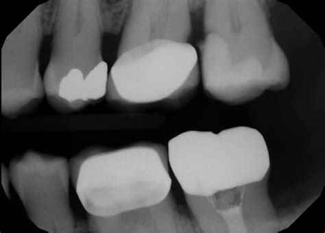 Best Practices For Class Ii Restorations Innovative Thermoviscous Bulk Fill Composite Dental Best Practices For Class Ii Restorations Innovative Thermoviscous Bulk Fill Composite Dental