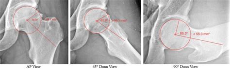 Body Mass Index Sex Tönnis And Outerbridge Grades But Not Cam Lesion Location Influence 10