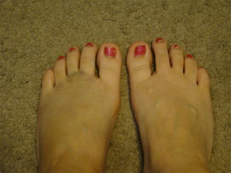 Fracture Foot X Ray Fracture Treatment