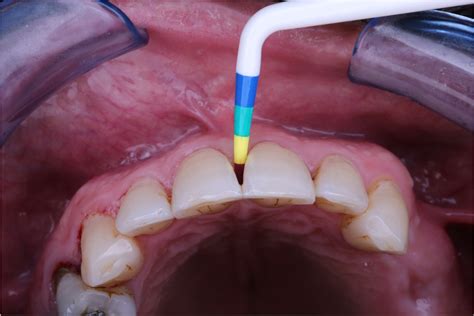 Gap Sizing For Bioclear Matrix Group Download Scientific Diagram