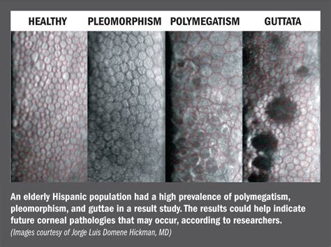Corneal Endothelium Characteristics Vary Depending On Patient Ethnicity
