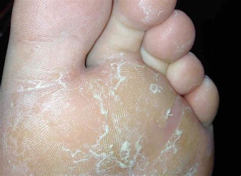 Pictures Of Athletes Foot On Bottom Of Feet Store