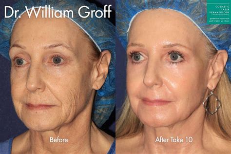 What Is The Best Treatment For Deep Facial Wrinkles Cosmetic Laser