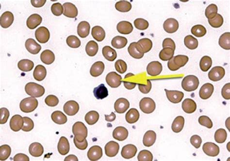 Red Blood Cell Morphology And Indices The Clinical Chemistry Interface