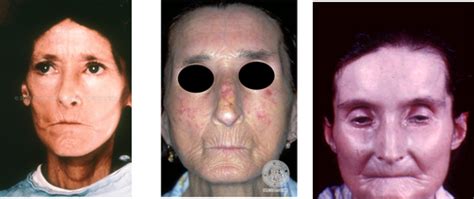 Scleroderma And Inflammatory Myopathies Flashcards Quizlet