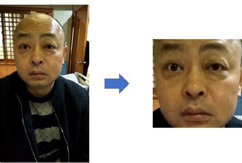 Figure 1 From Quantitative Analysis Of Facial Paralysis Based On Tcm