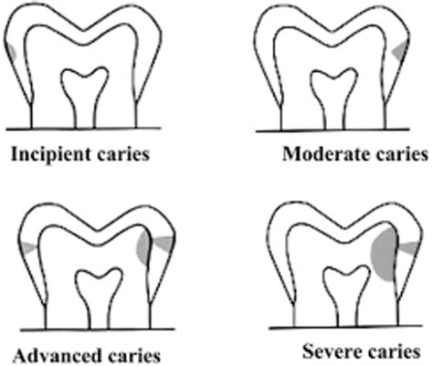 Den 121 Caries Flashcards Quizlet