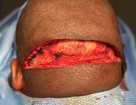 Plastic Surgery Case Study Scalp Roll Excision With Nuchal Ridge