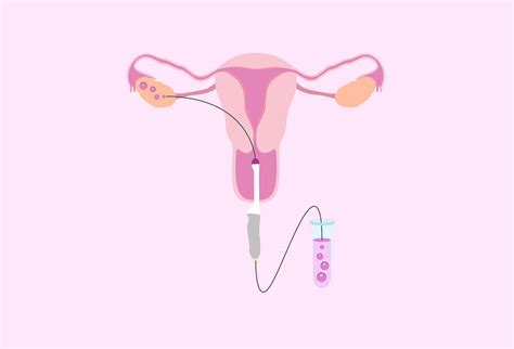 Ivf Centre In Delhi Egg Retrieval Process Dr Rhythm Gupta