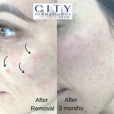 Before And After Photos Mole Removals