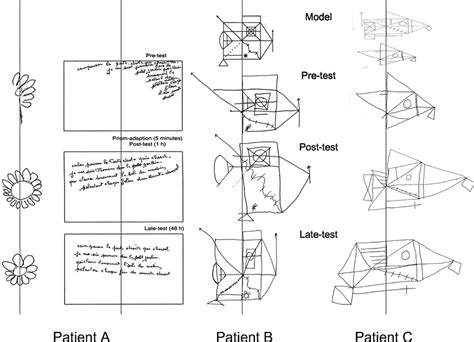 4 Left Object Centered Neglect Spatial Dysgraphia And Download Scientific Diagram