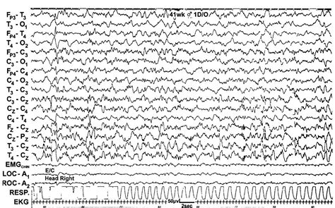 An Eeg Segment Of A 41 Week 1 Day Old Female That Documents
