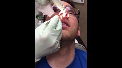 Deviated Septum Splint Removal Youtube