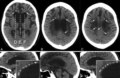 A C Case 1 Small Bilateral Calcifications In The Frontal And Parietal