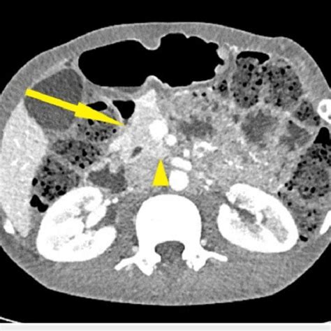 Cect Showing The Head Solid Arrow And Uncinate Process Arrowhead Of Download Scientific