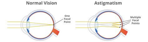Can Astigmatism Get Worse Common Refractive Errors