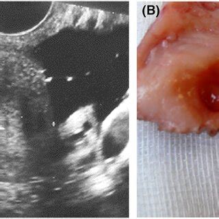 A Transvaginal Ultrasound The Rightsided Nodule With Hypoechoic Download Scientific
