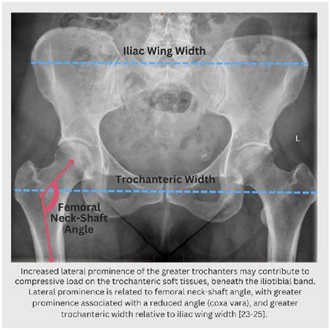 Bony Features Associated With Gluteal Tendinopathy Download