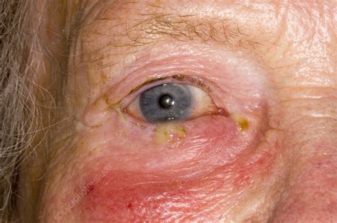 Orbital Cellulitis Stock Image M130 0914 Science Photo Library