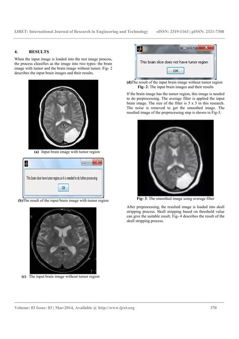 Brain Tumor Detection And Segmentation Using Watershed Segmentation And
