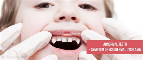 Ectodermal Dysplasia Teeth