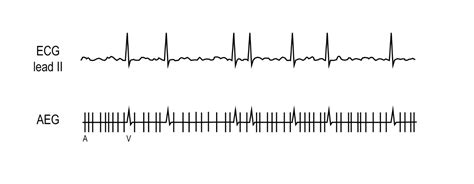 Atrial Fibrillation Af Atrial Electrogram Education Uw Madison