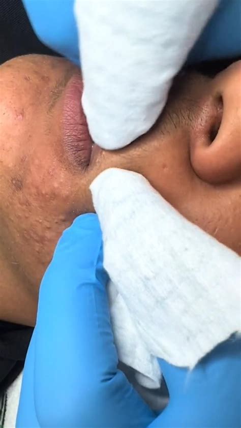 Blackheads Mout Blackheads Mouth Lip Blackheads Mouth Area