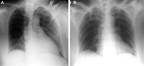 Lung Hyperlucency Chest