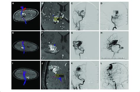 Preoperative Magnetic Resonance Angiography Mra Fused With The