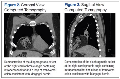 Colonic Dyspnea And The Morgagni Hernia A Rare Adult Diagnosis Mdedge