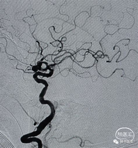 中枢介入第347期：大脑中动脉瘤分叉部动脉瘤出血 双微导管长圈技术裸栓 脑医汇 神外资讯 神介资讯
