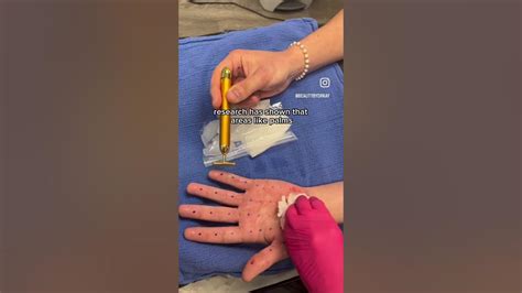 Have You Heard Of Palmar Hyperhidrosis Aka Excessive Palm Sweating 🤲💦