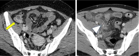 Imaging Of Acute Appendicitis For Adult Patients Radiology And