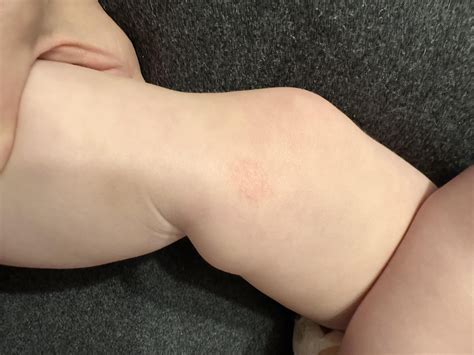 Persistent Ringworm R Dermatologyquestions