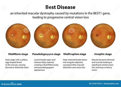 Stages Of Best Vitelliform Macular Dystrophy Illustration 272070831