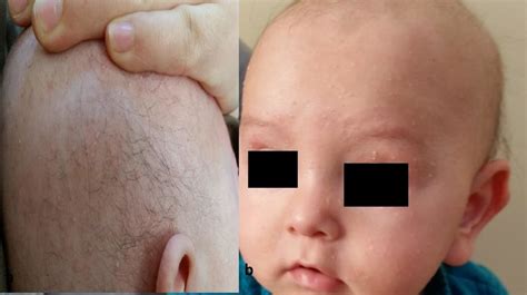 A B Case 3 Multiple Milias On The Scalp And Hypotrichosis Of Scalp Download Scientific