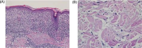 A Mildly Atrophic Epidermis With Prominent Basal Layer Degeneration