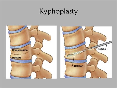 Kyphoplasty Recovery Time New Health Advisor