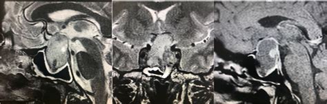 Pre Operative Magnetic Resonance Images Demonstrating A Large Pituitary