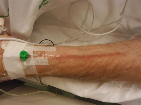 Nursing Iv Complications Phlebitis Infiltration