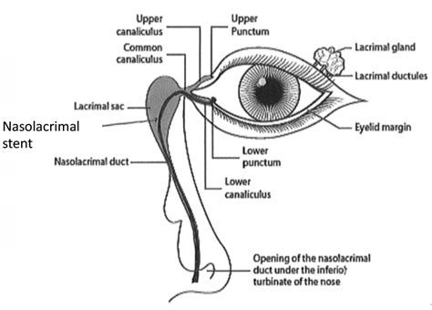 Lacrimal Obstruction — Dr Ye Chen · Ophthalmic Surgeon · Oculoplastic